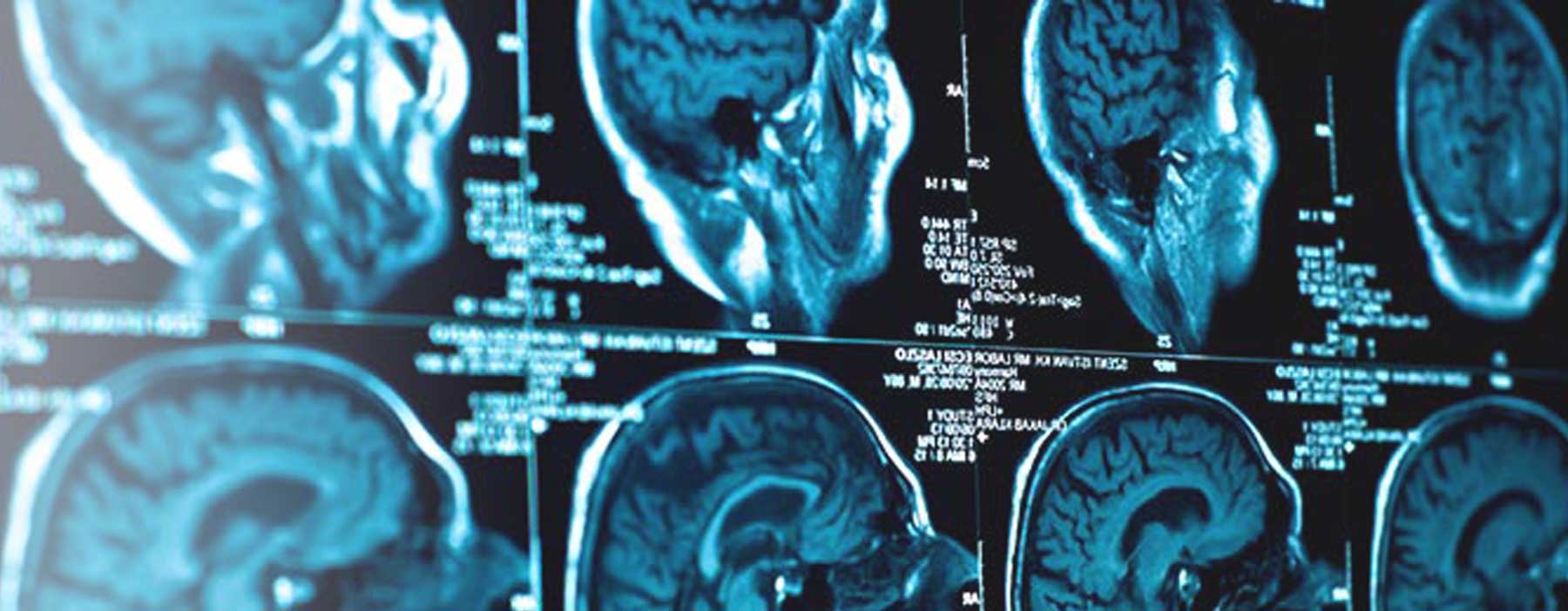 Dallas, TX Brain Injury Lawyer | Crain Brogdon, LLP